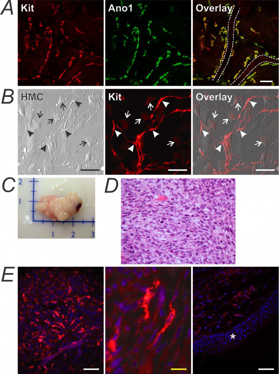 Cellular origin of GIST from the “good” cells’ perspective - The Life ...